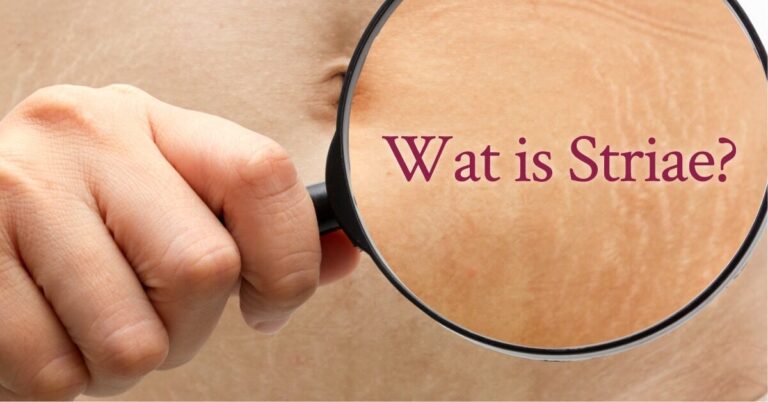 Striae: Wat is het, hoe Voorkom je het en hoe Verminder je het?