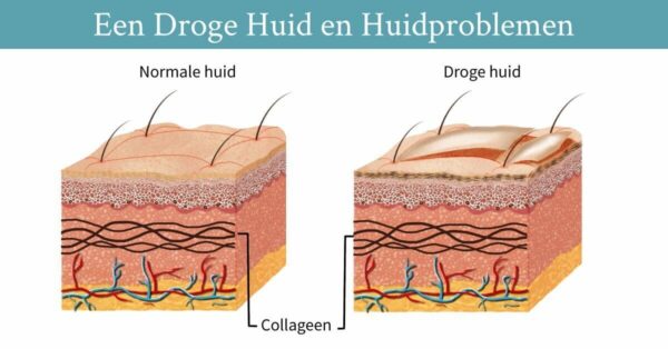 Een Droge huid, Oorzaken, Verzorging en Handige Tips!