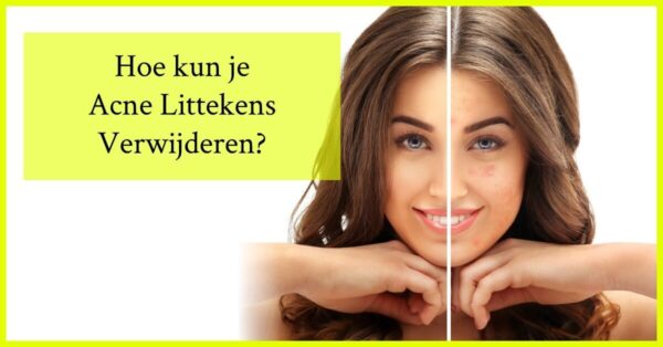Voorkom en Vervaag Acne Littekens met deze Simpele Tips